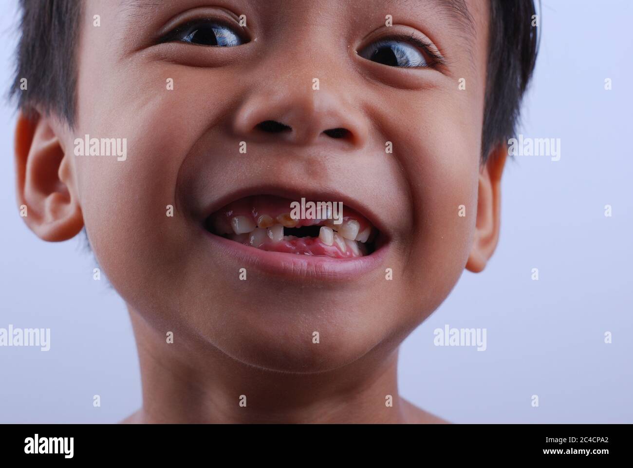 Boy broken teeth hi-res stock photography and images - Alamy