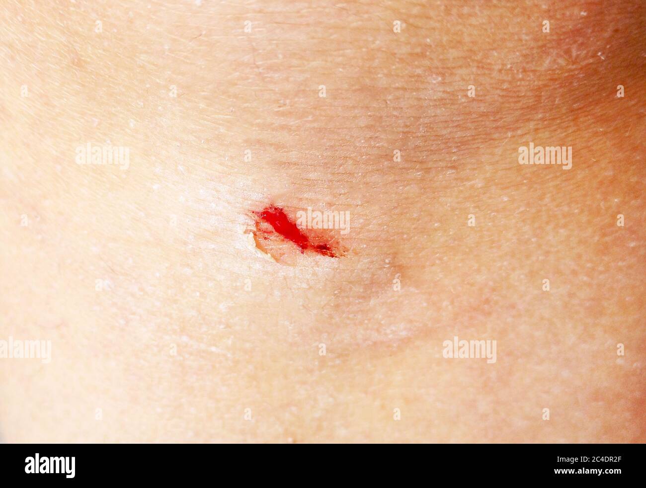 Black eye wound hi-res stock photography and images - Alamy