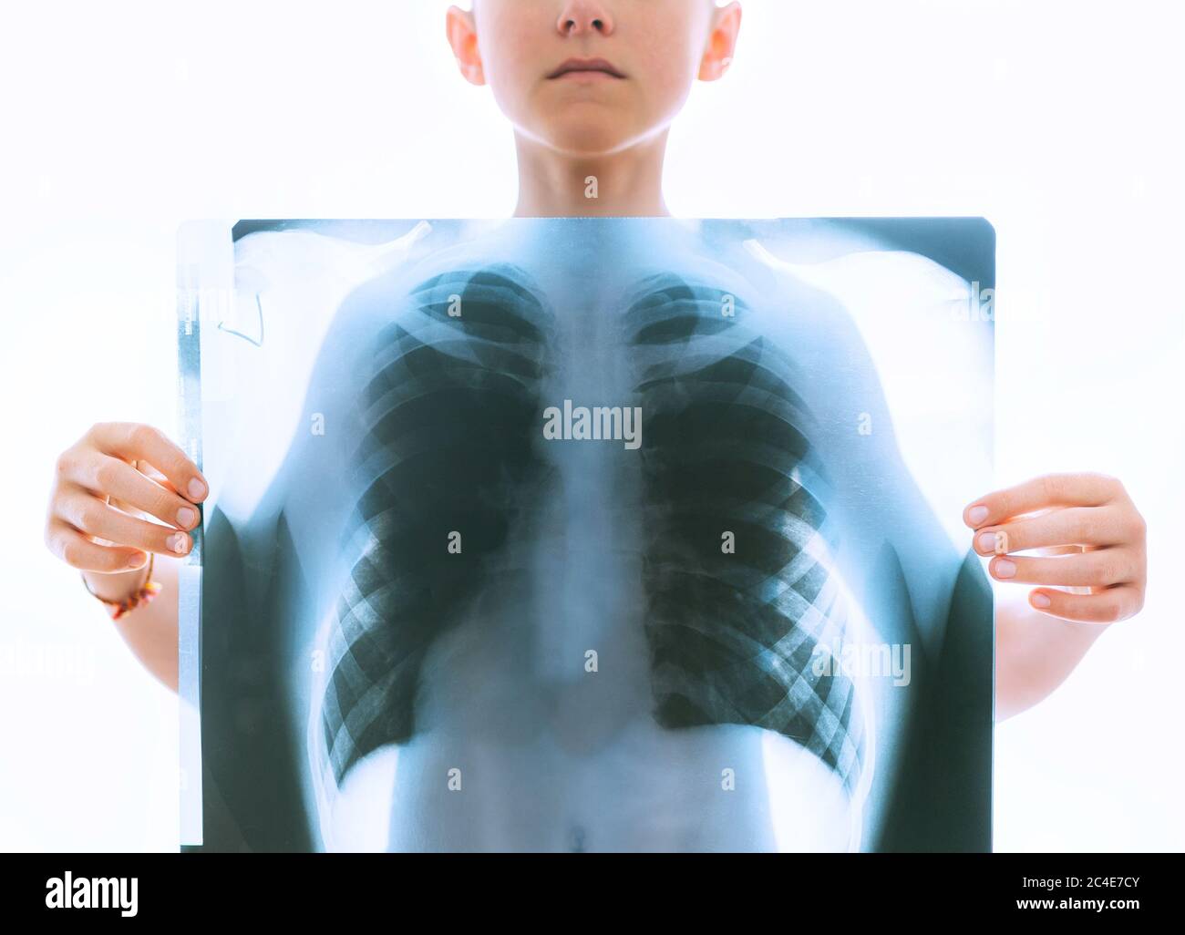 Young teenage boy holding a chest and lungs x-ray film scan in front of ...