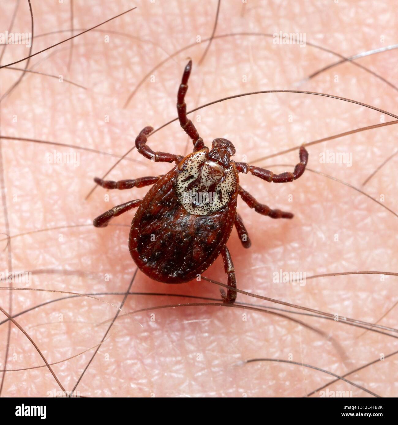 Macro photo of a tick crawling along a human hairy skin. A parasite ...