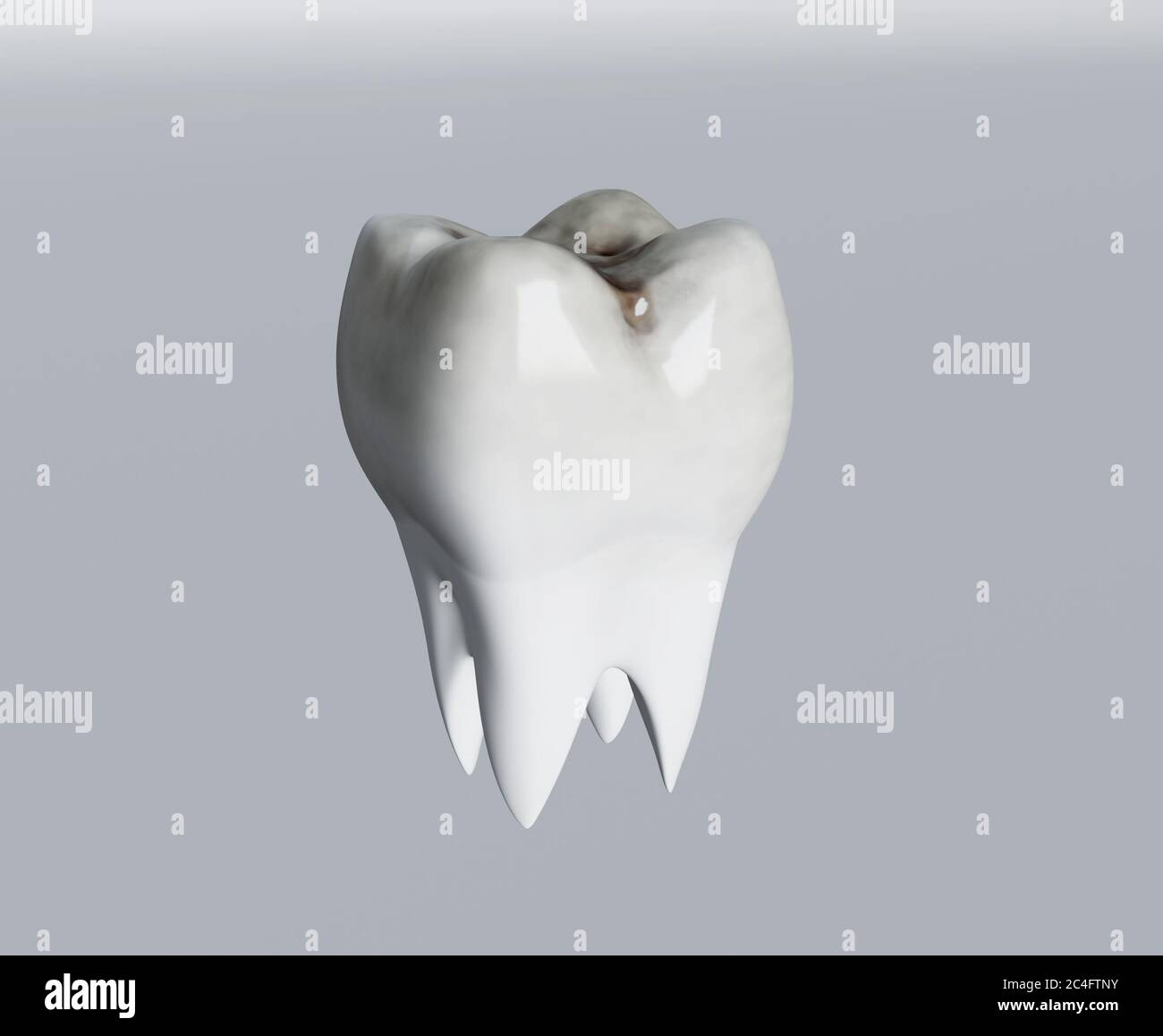 Cavities of molar tooth, tooth decay, caries. 3d illustration Stock ...