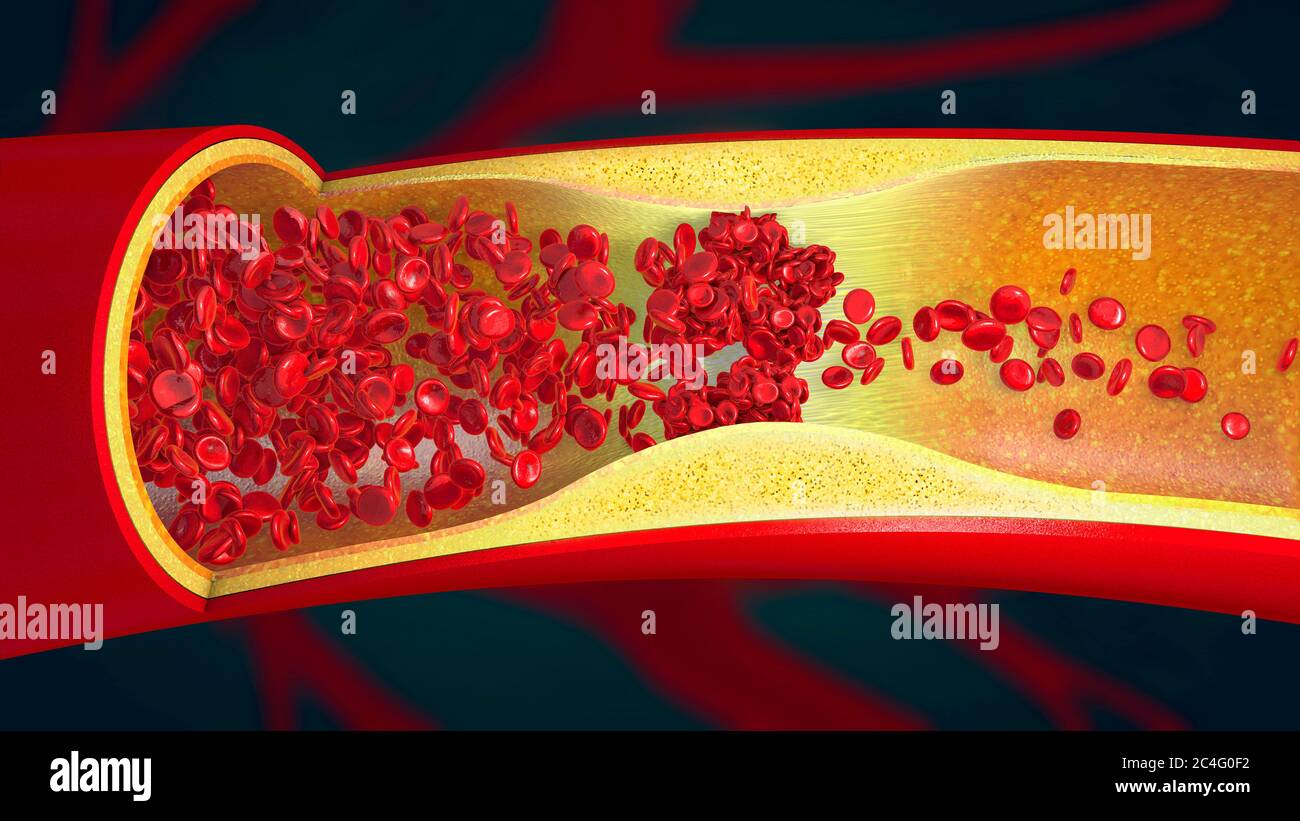Pulmonary artery blood clot hi-res stock photography and images - Alamy