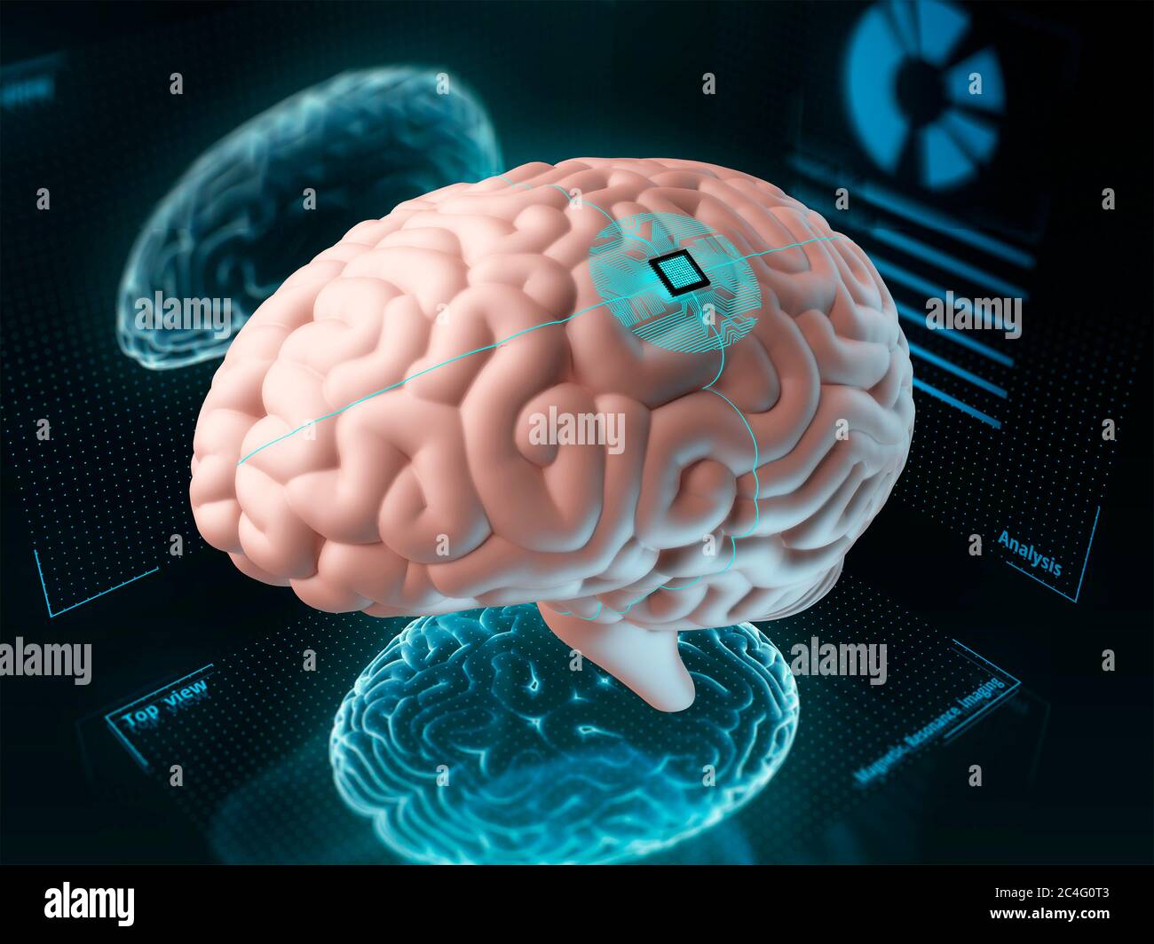 Chip implanted in human brain hi-res stock photography and images - Alamy