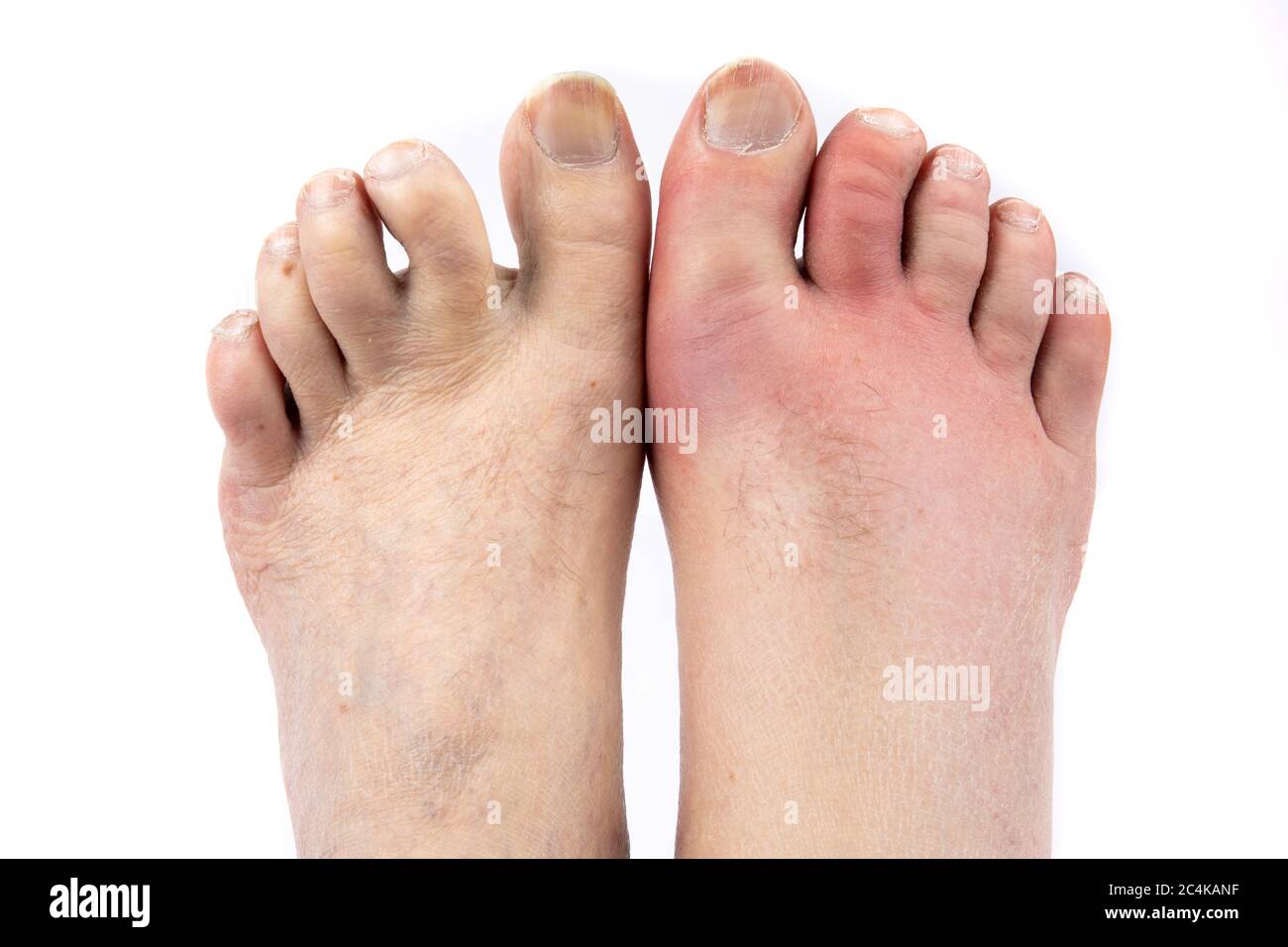 Gout Both Feet