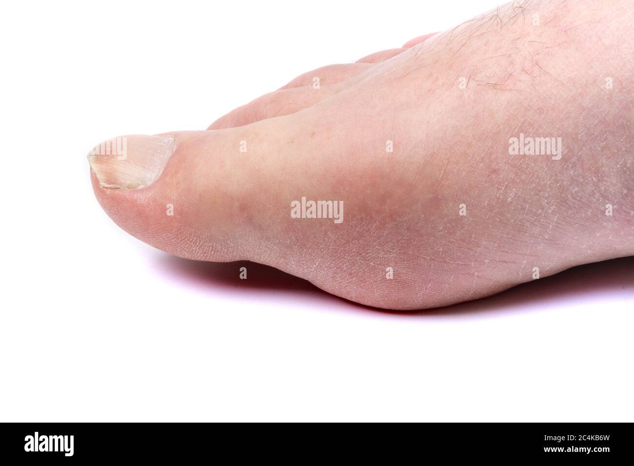Gout Foot High Resolution Stock Photography and Images - Alamy