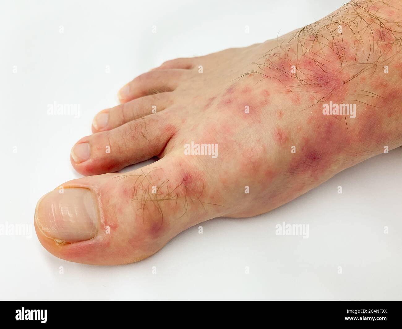 Close up of male's foot and toes with red rash desease on a white ...