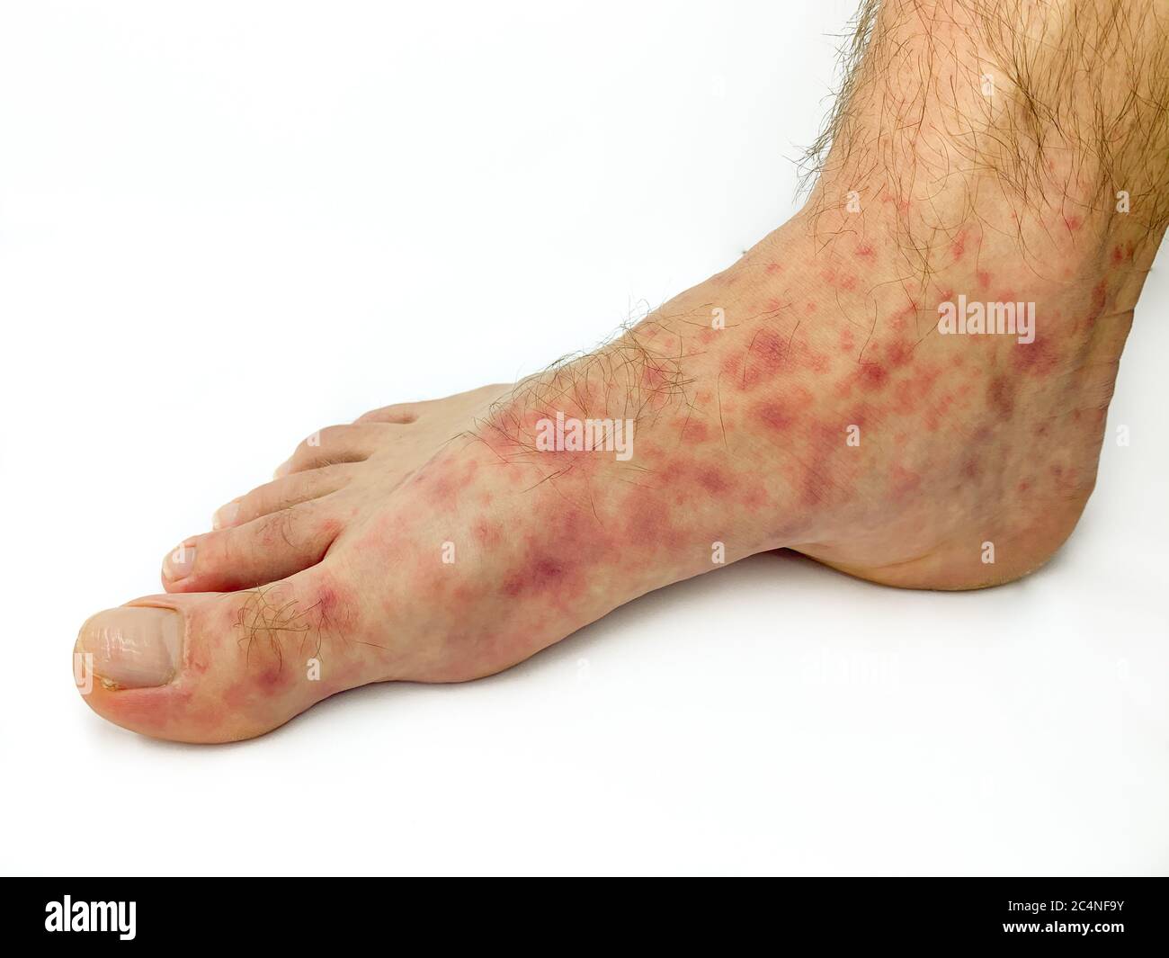 Close up of male's foot and toes with red rash desease isolated on a ...