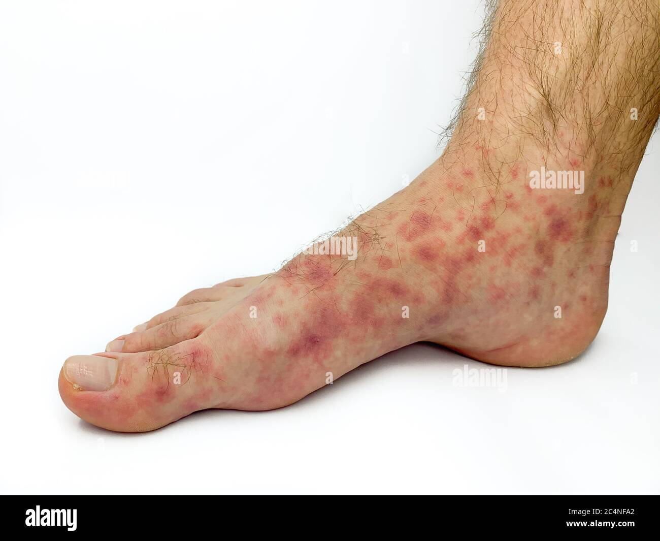 Allergy erosion hi-res stock photography and images - Alamy