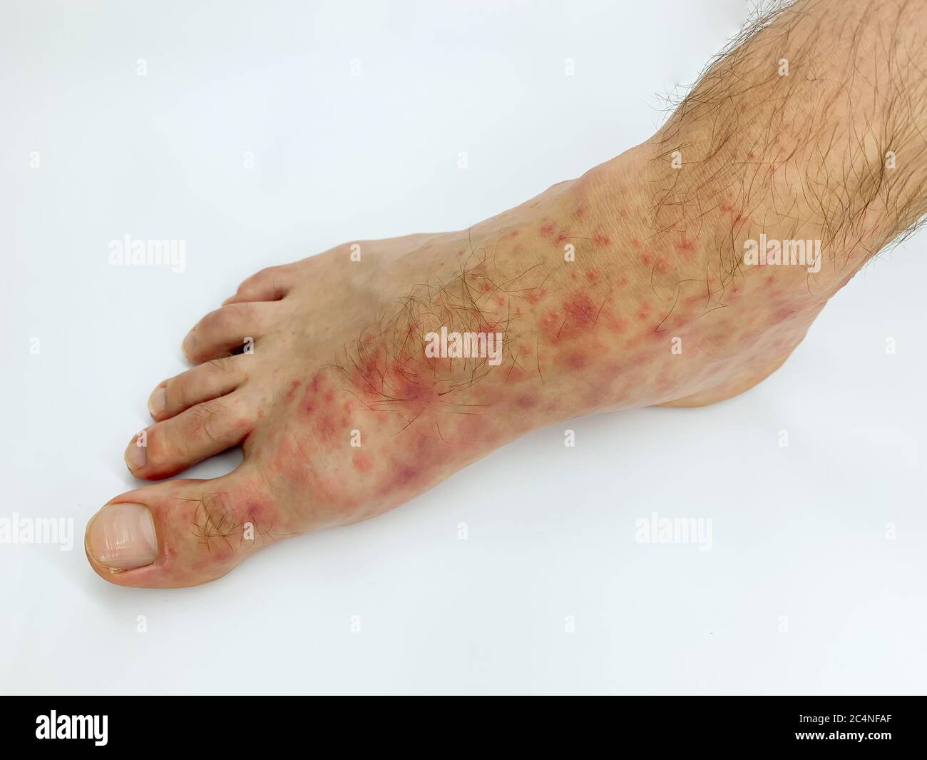 Allergy erosion hi-res stock photography and images - Alamy