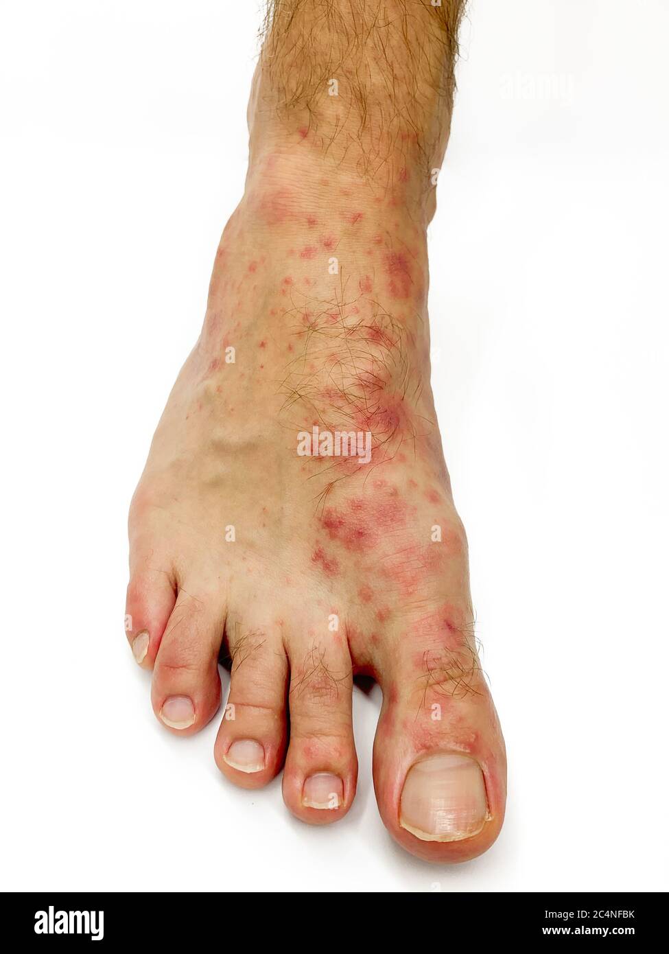 Close up of male's foot and toes with red rash desease isolated on a ...