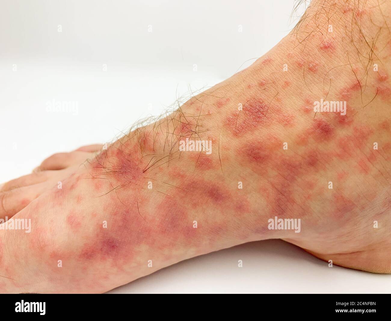 Close up of male's foot and toes with red rash desease on a white ...