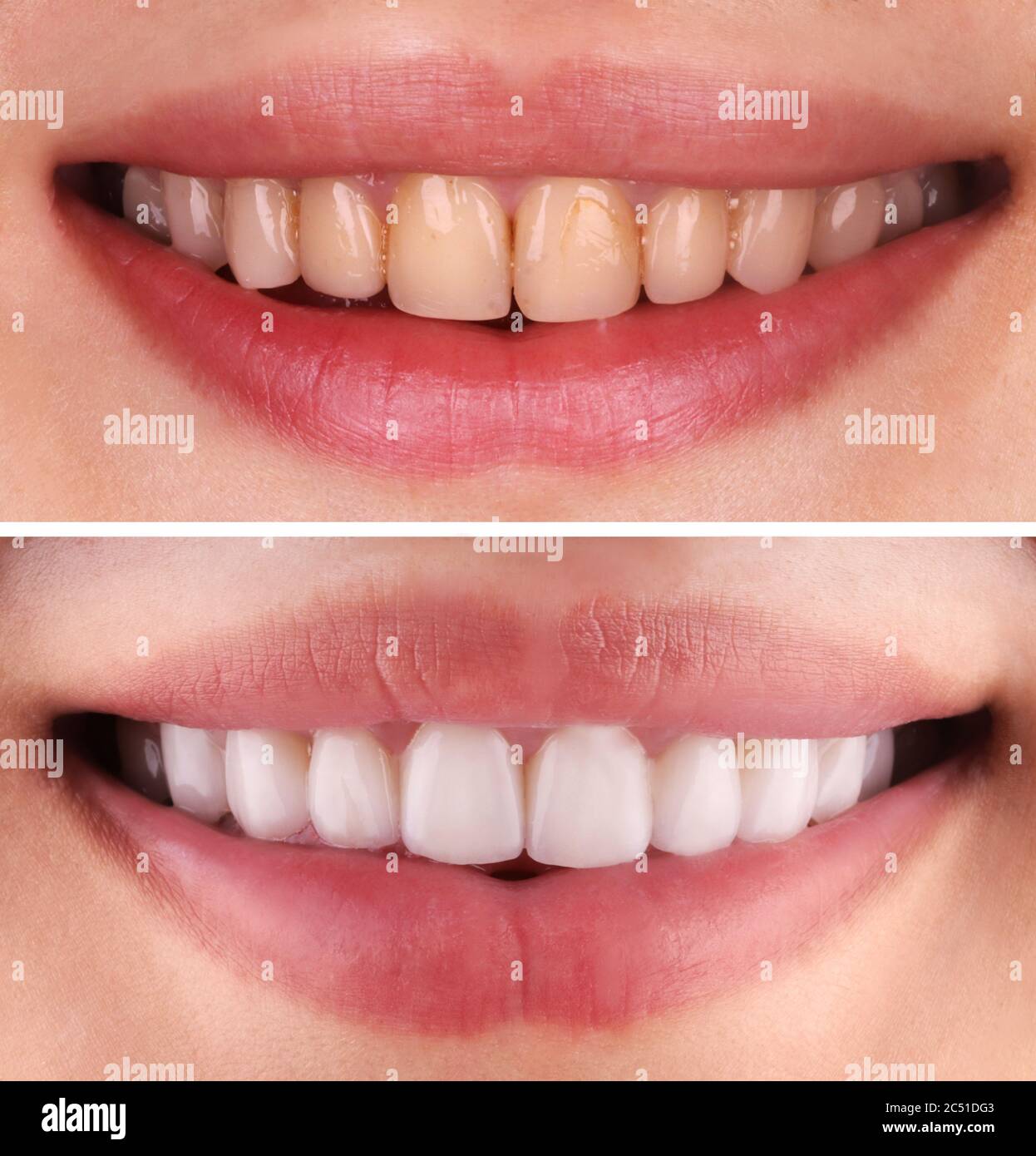 Perfect Smile Before And After