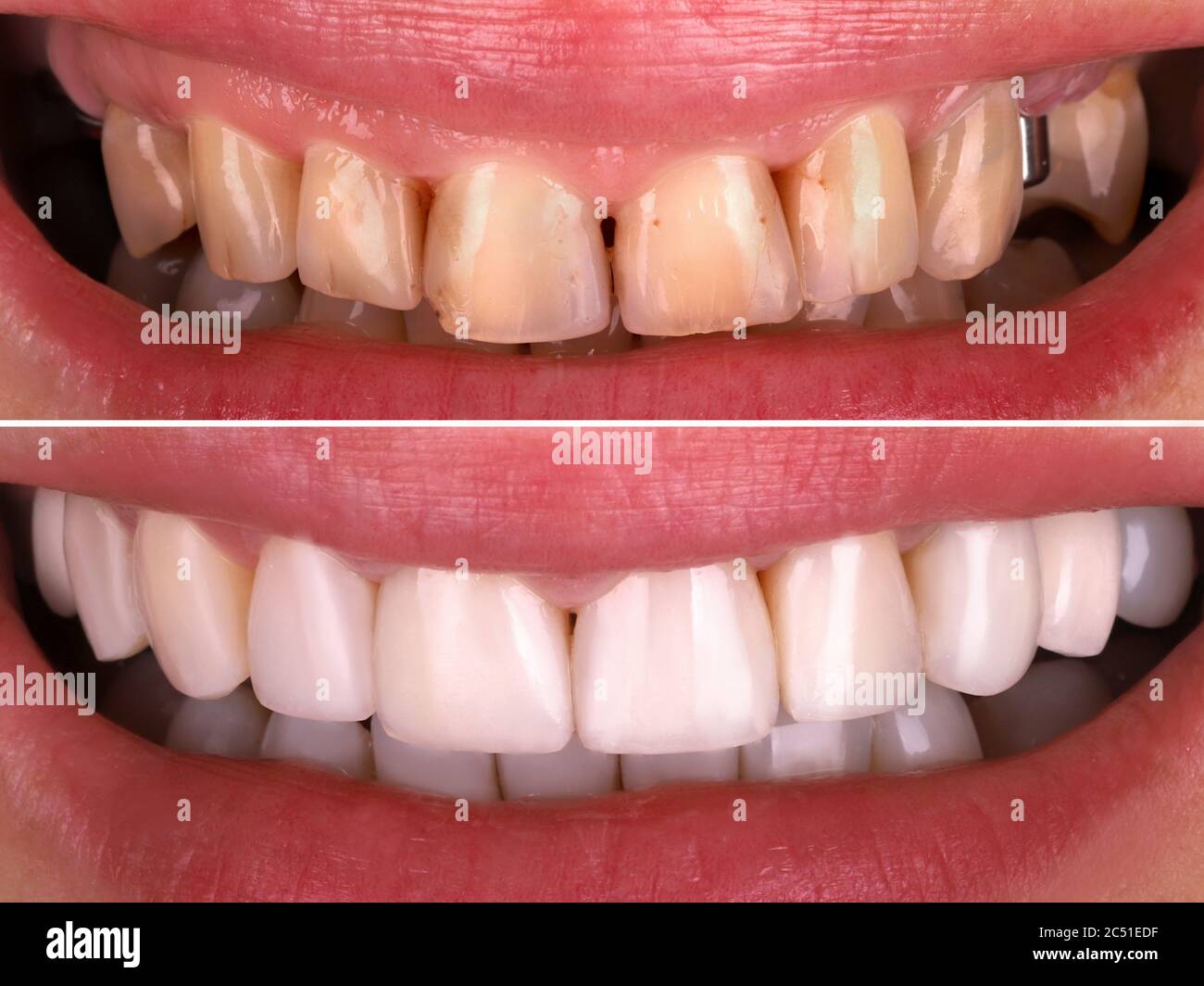 Perfect smile before and after bleaching procedure whitening of young ...