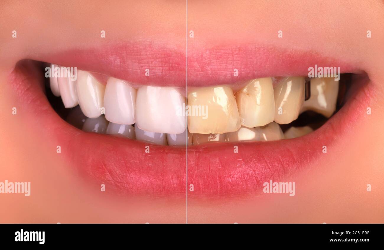 Perfect smile before and after bleaching procedure whitening of young ...