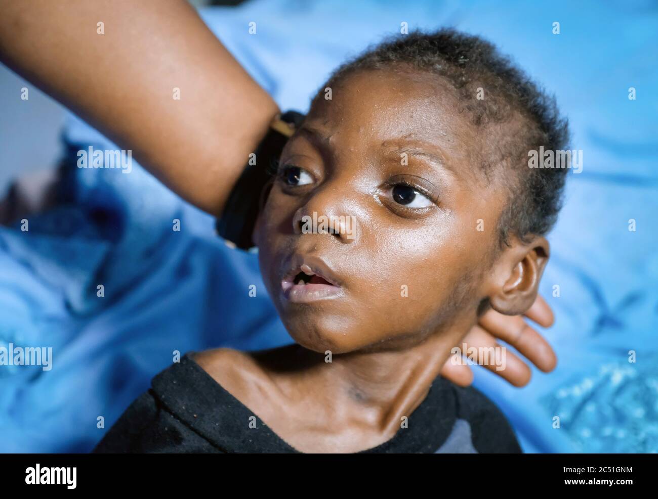 Malnourished boy hi-res stock photography and images - Alamy