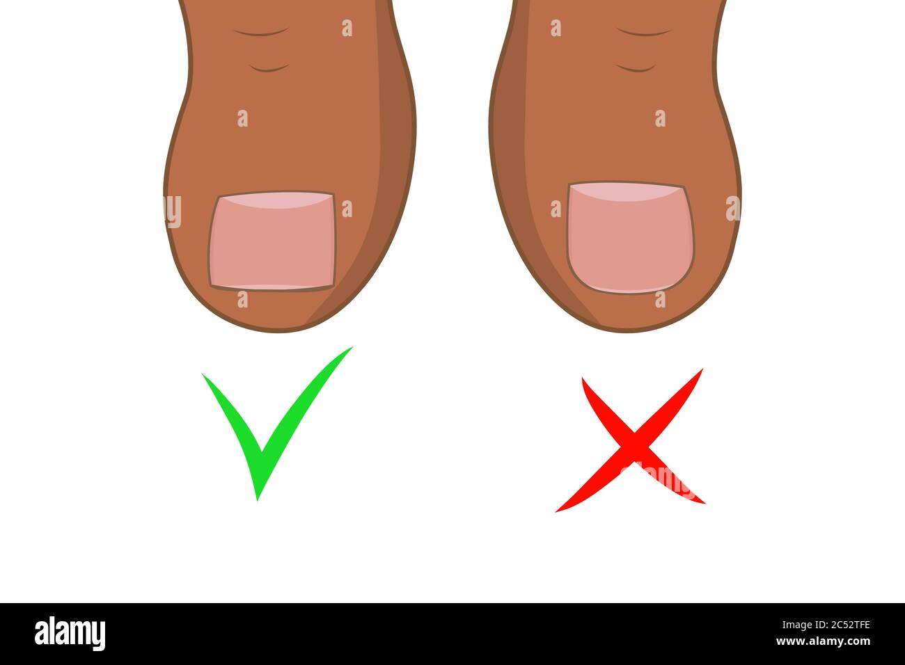 Right to cut toenails. Ingrown toe nail. Pedicure foot sole vector ...