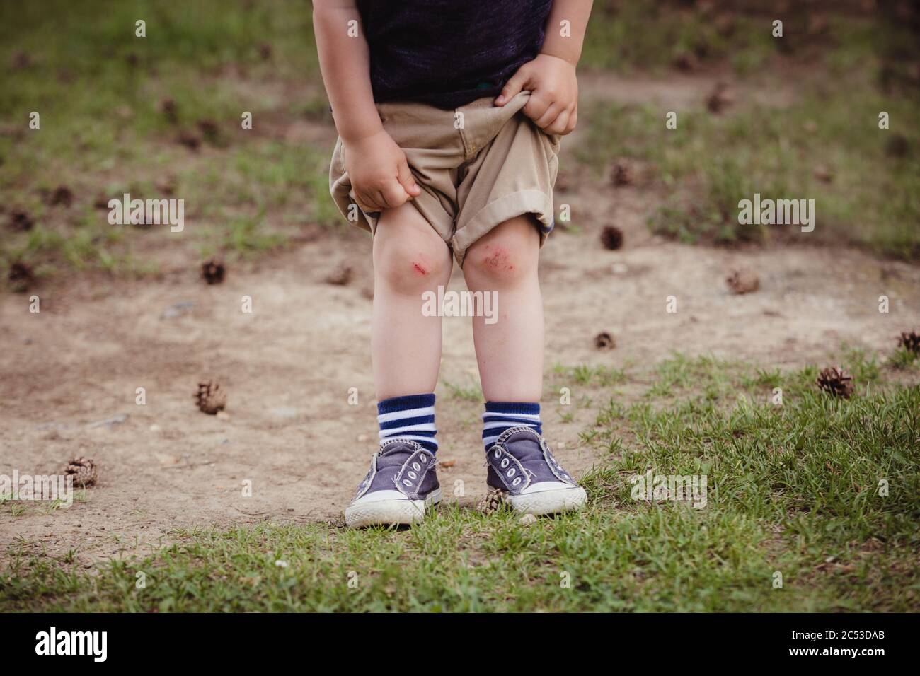 Small boy in shorts showing his broken children's knees Stock Photo - Alamy
