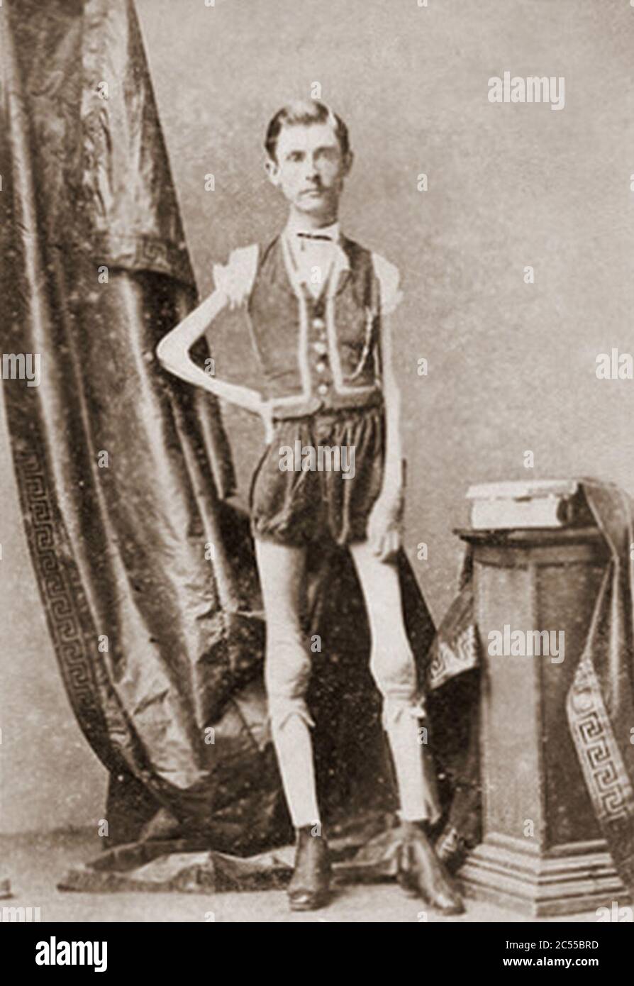 Isaac W Sprague living skeleton 1867 Stock Photo - Alamy