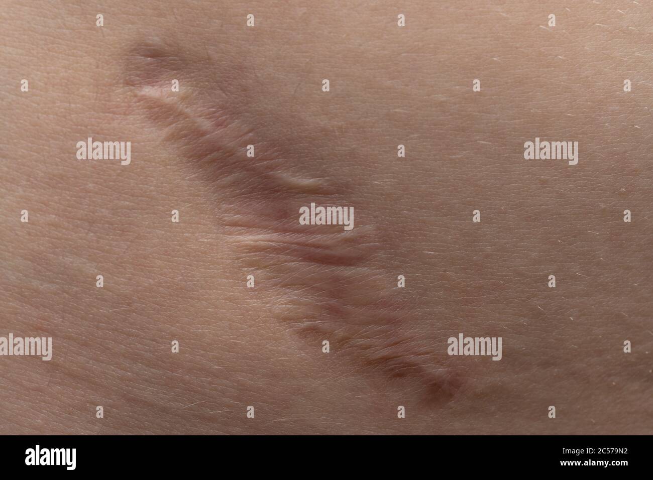 Appendicitis scar hi-res stock photography and images - Alamy