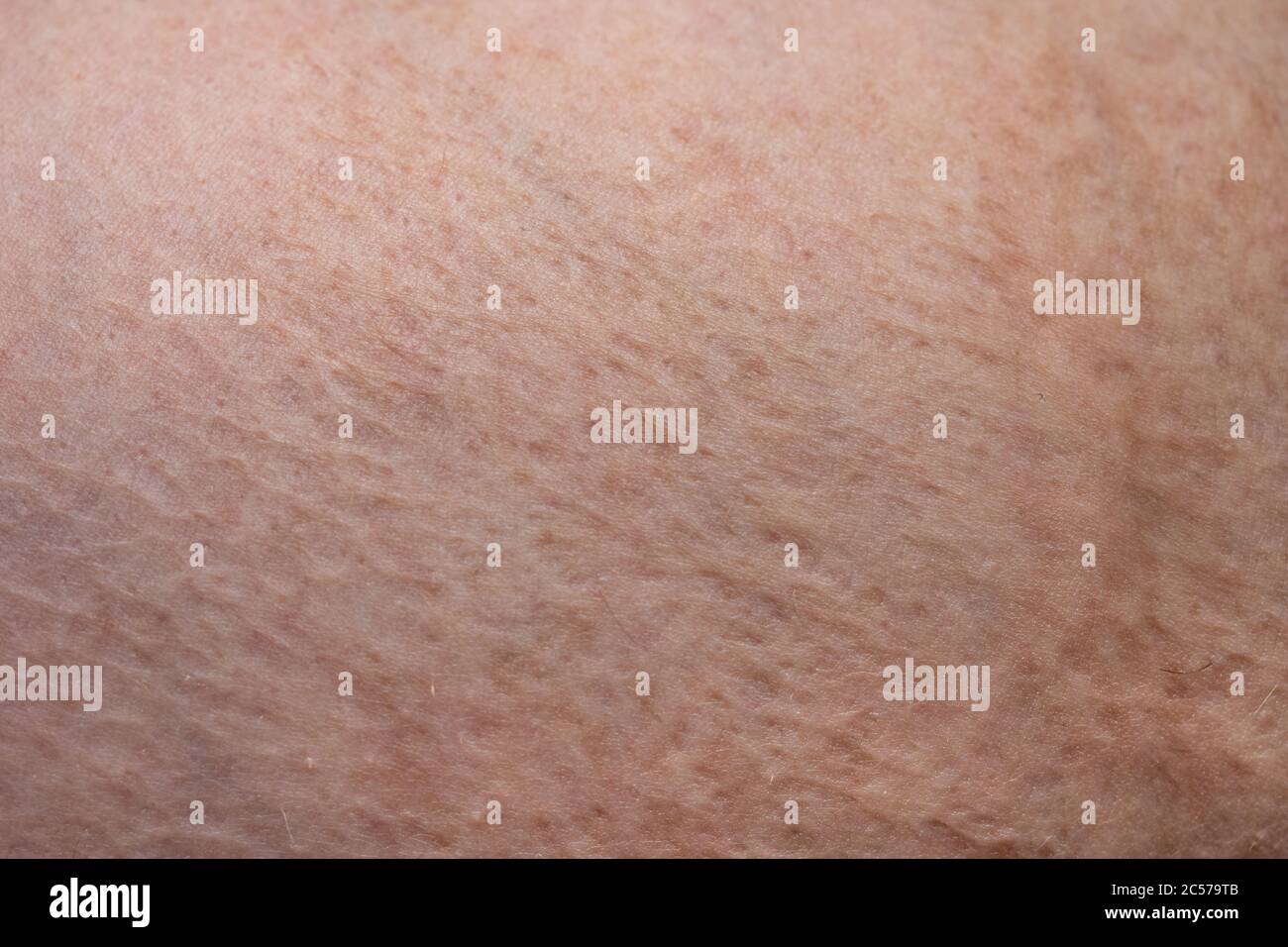 Burn scar hi-res stock photography and images - Alamy
