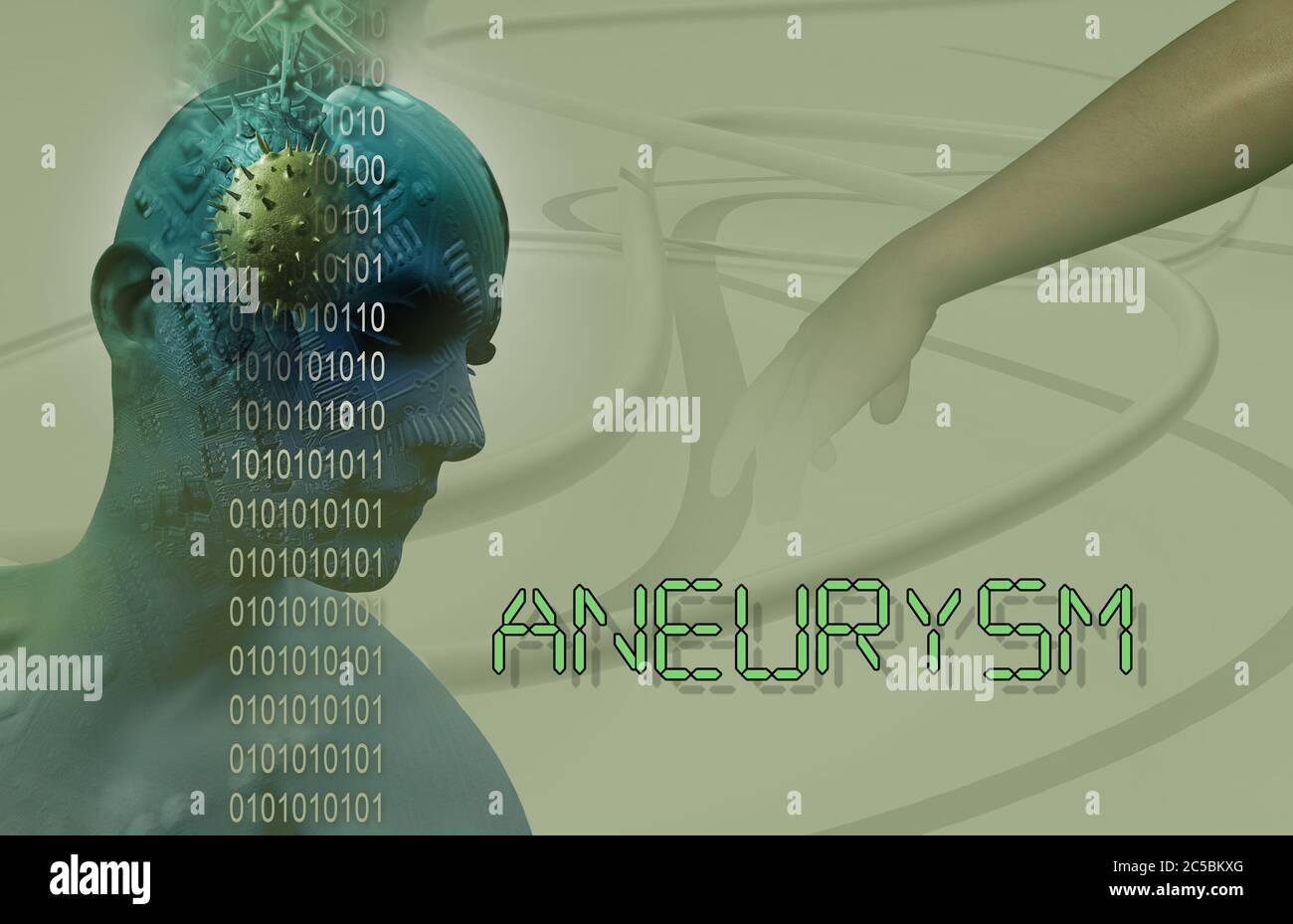3d Medical illustration of brain aneurysm Stock Photo - Alamy