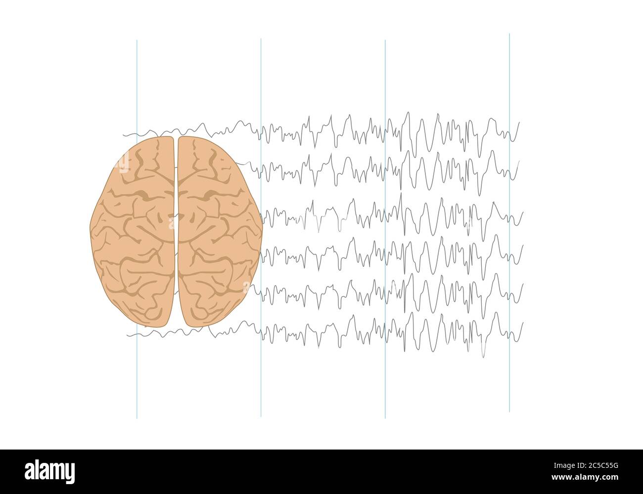 Seizure Brain Waves