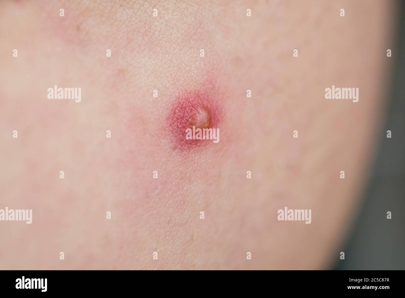 Pustule High Resolution Stock Photography and Images - Alamy