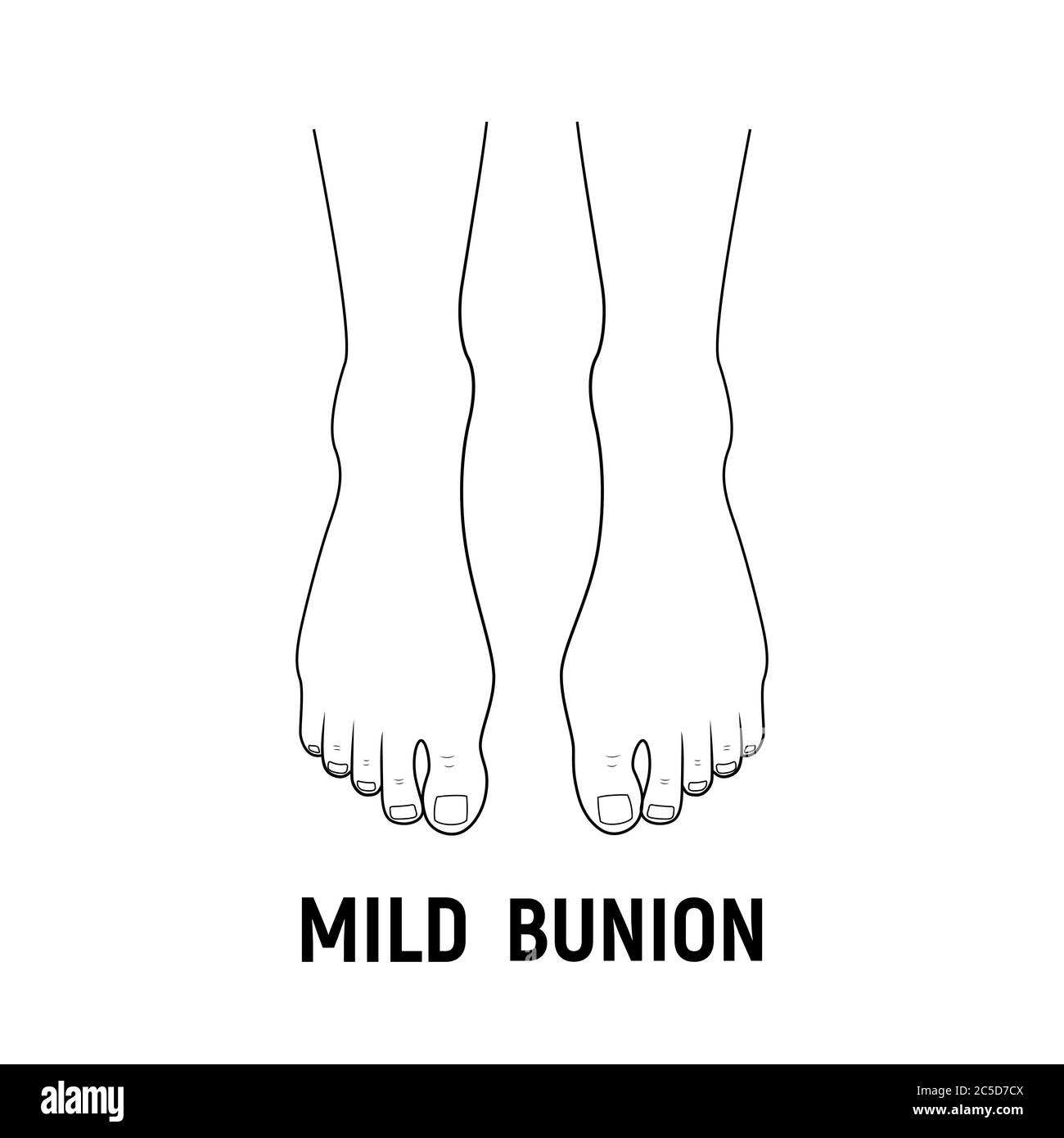 Hallux valgus, mild bunion. Vector illustration. Orthopedics foot ...