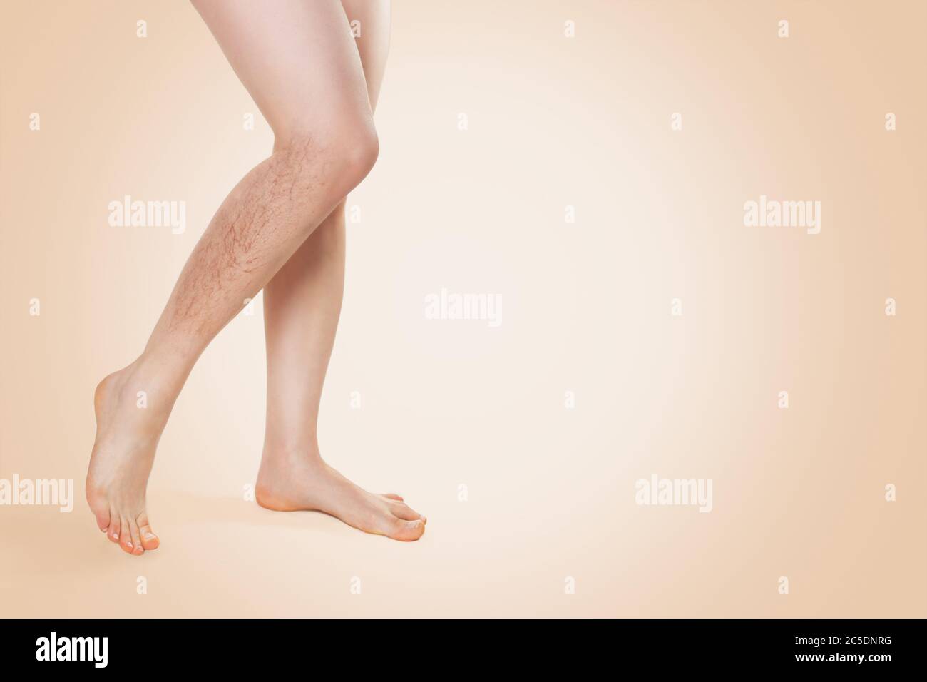 Smooth female legs, with varicose veins on the lower leg. Beige ...