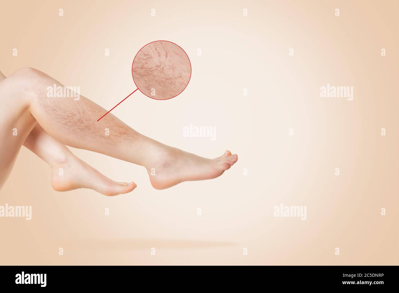 Smooth female legs, with varicose veins on the lower leg. Zoomed image ...