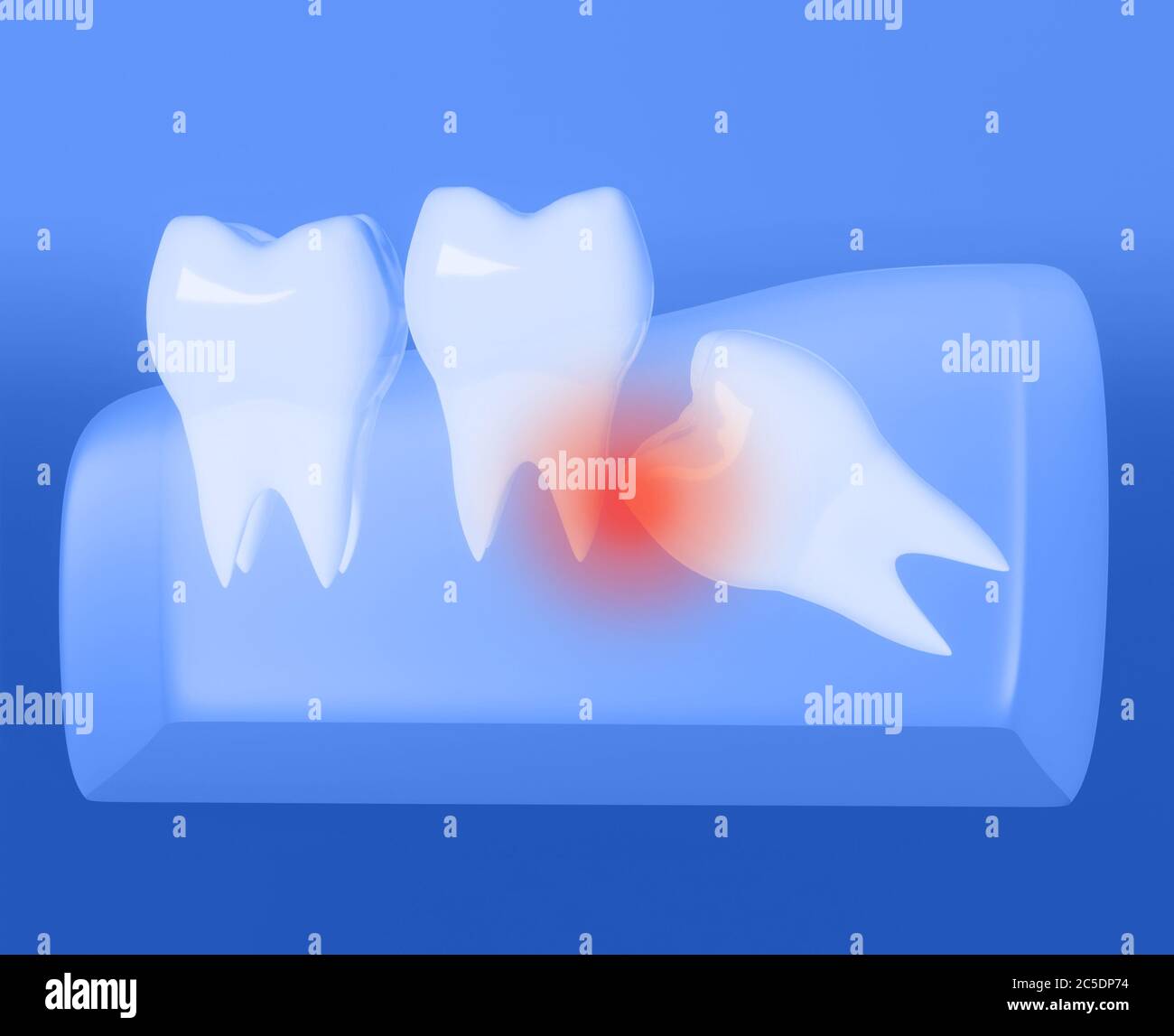 Wisdom tooth grows wrong, wisdom tooth problem, horizontal position of ...