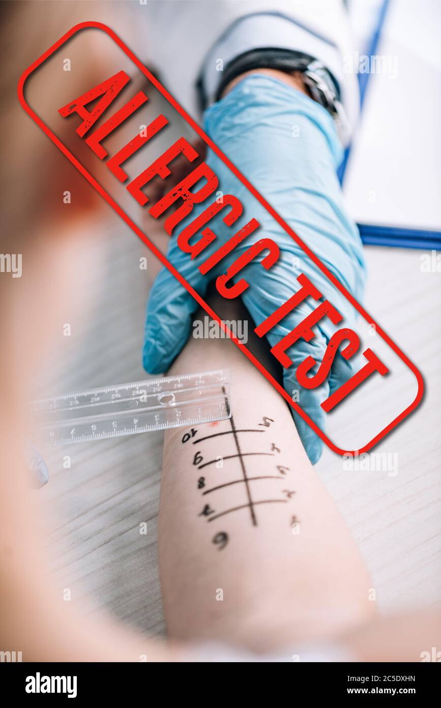 cropped view of allergist holding ruler near marked hand of woman with ...