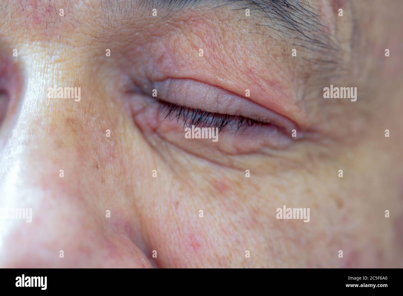 Extreme close-up photography of the atocpic dermatitis symptoms on the ...