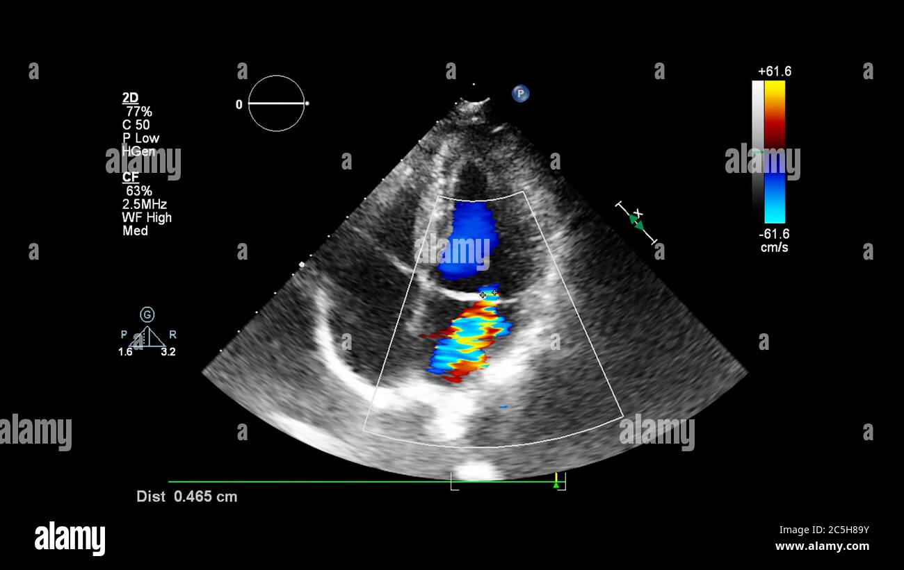 Doppler aorta hi-res stock photography and images - Alamy