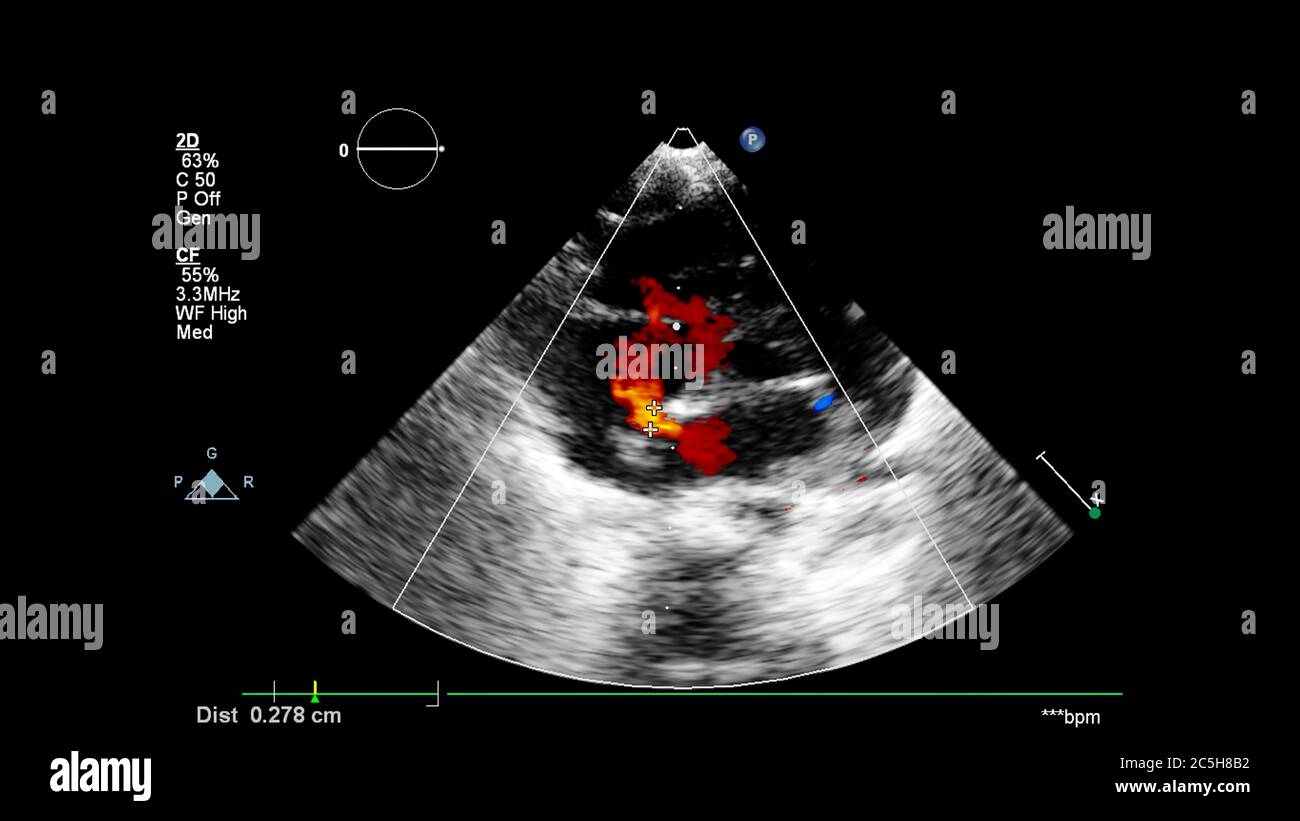 Image of the heart during transesophageal ultrasound with Doppler mode ...