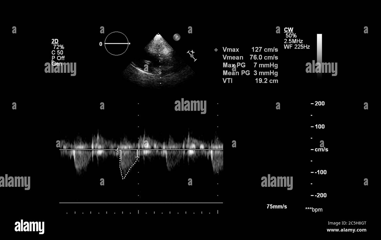 Image of the heart in gray-scale mode during transesophageal ultrasound ...