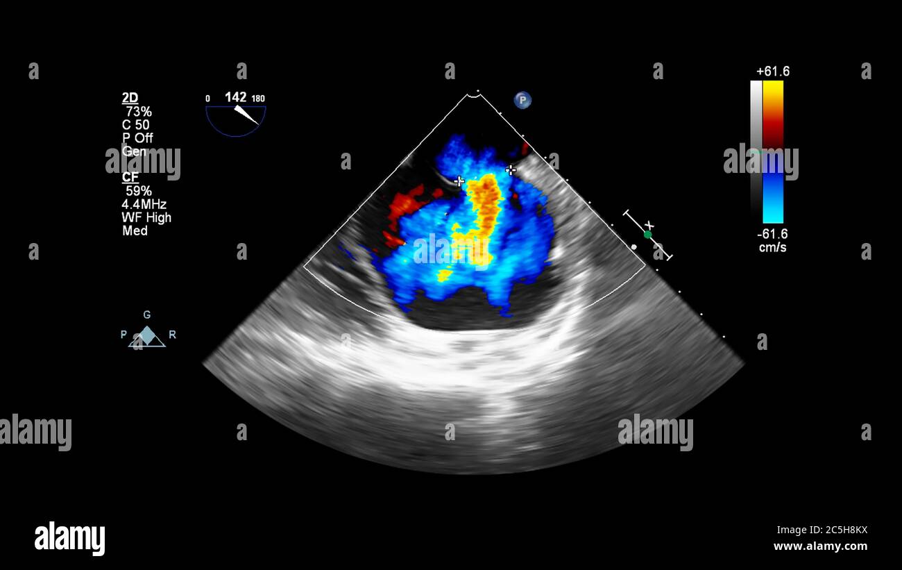 Image of the heart during transesophageal ultrasound with Doppler mode ...