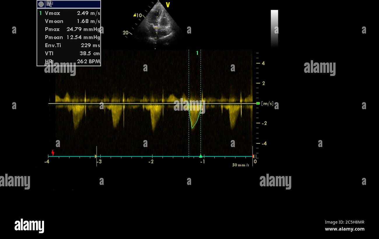 Image of the heart in gray-scale mode during transesophageal ultrasound ...