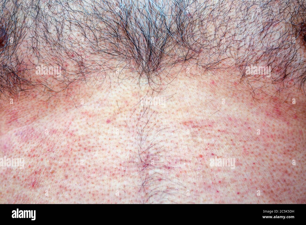 Eczema Atopic Dermatitis Symptom Skin High Resolution Stock Photography ...