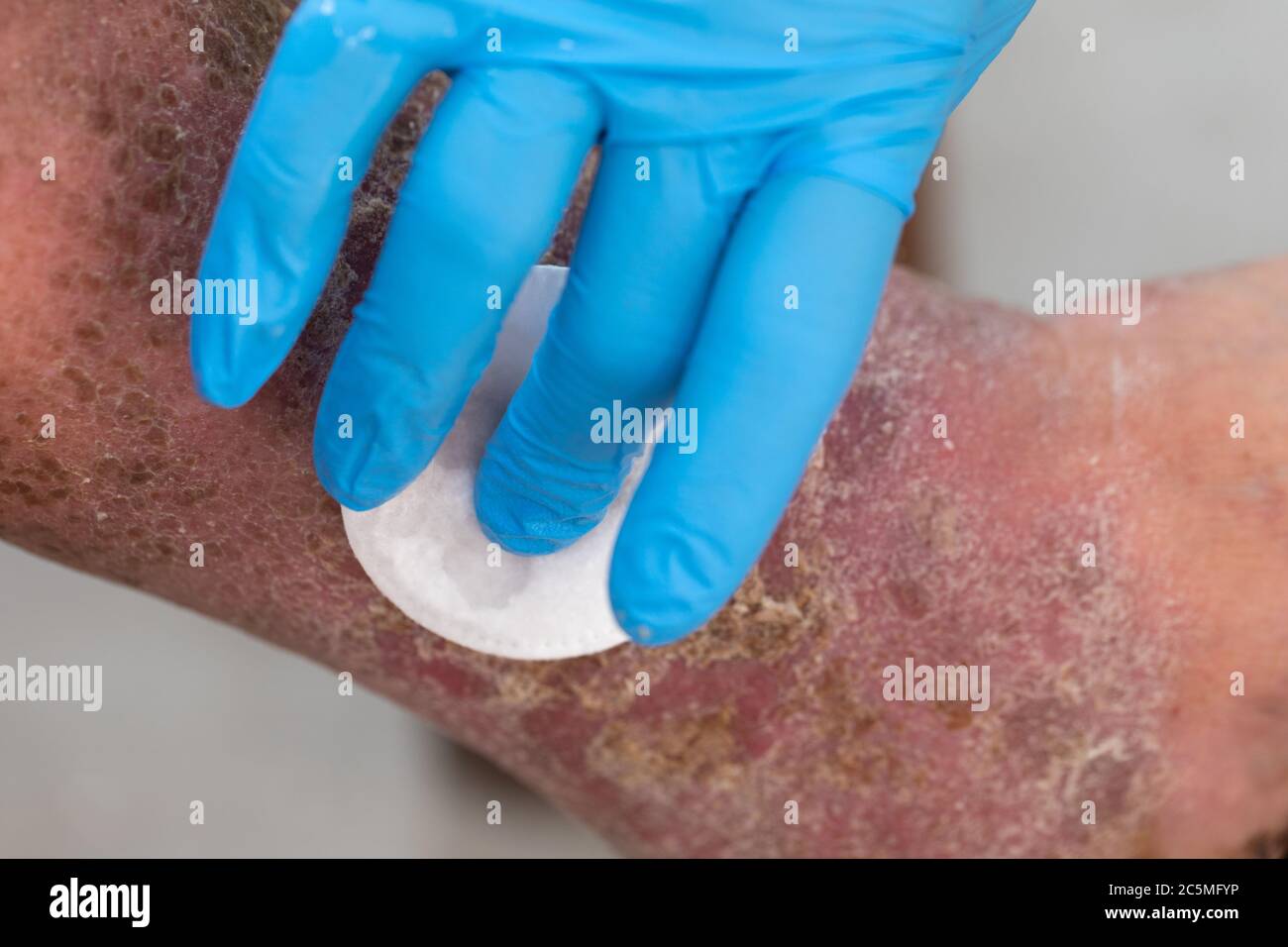 Close up picture of an infected wound on foot Stock Photo - Alamy