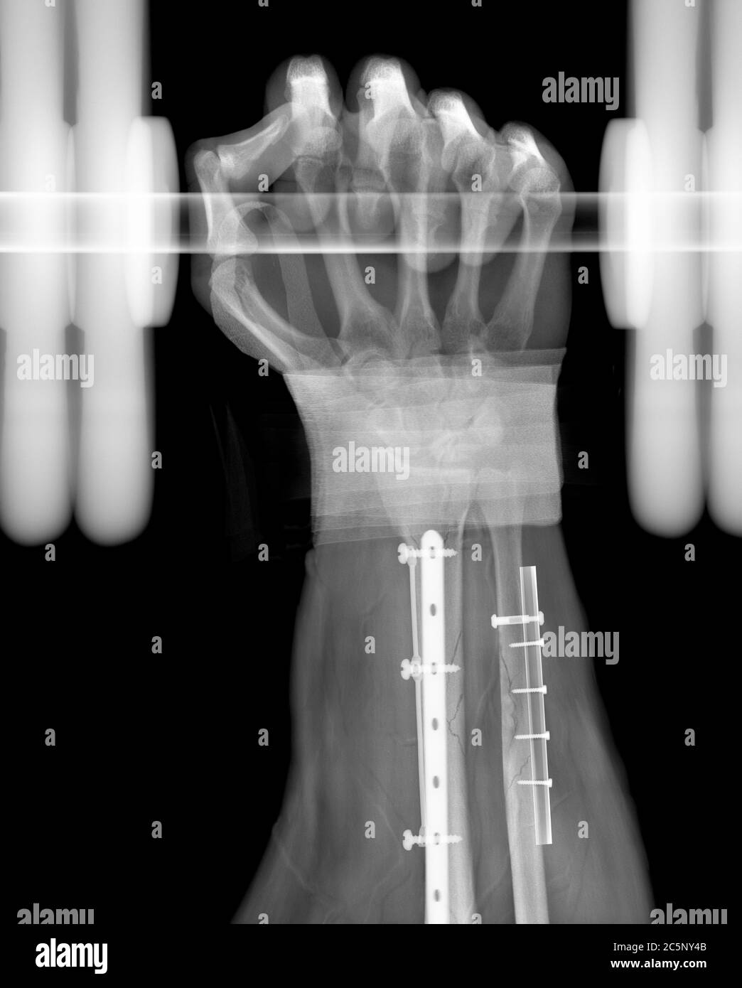 Broken arm, X-ray Stock Photo - Alamy