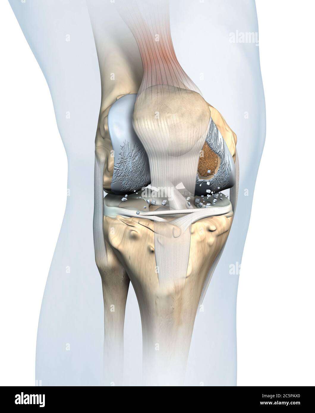 Illustration showing painful rheumatoid arthritis knee joint Stock ...