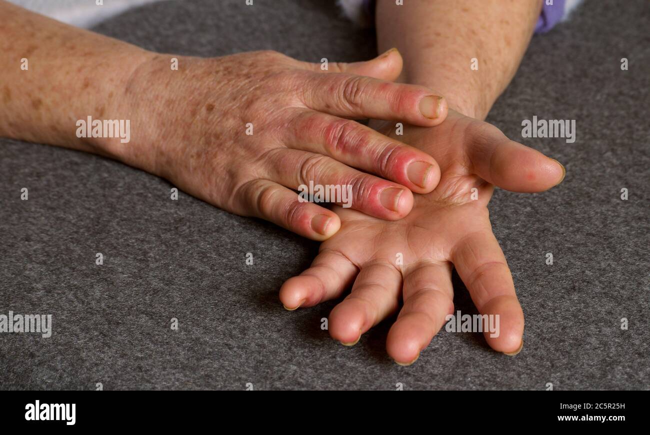 Frailty syndrome hi-res stock photography and images - Alamy