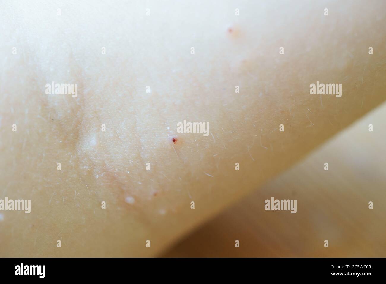 Contagiosum High Resolution Stock Photography and Images - Alamy