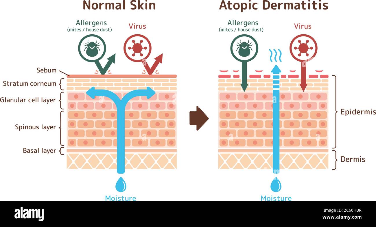 Sectional view of atopic dermatitis and normal skin / Comparative ...