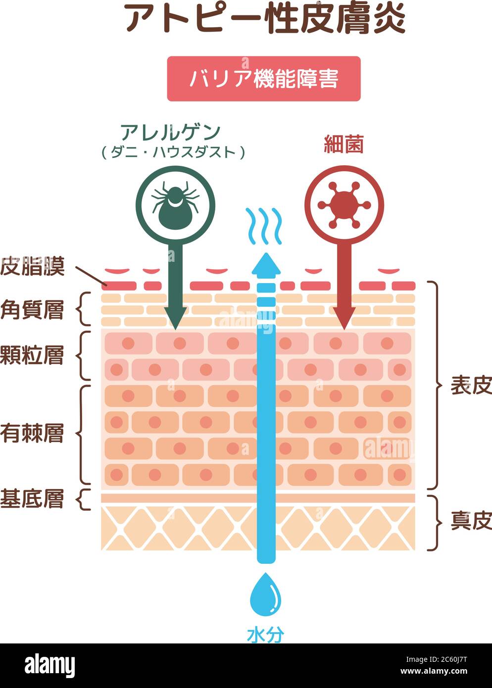 Sectional view of atopic dermatitis / vector illustration Stock Vector ...
