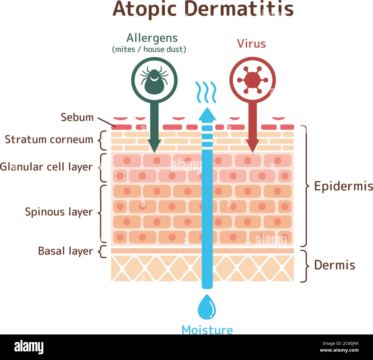 Sectional view of atopic dermatitis / vector illustration Stock Vector ...