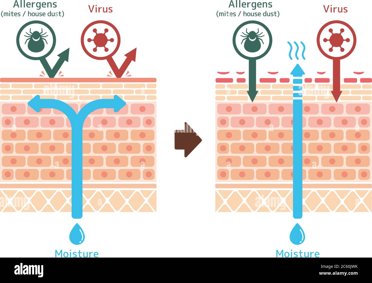 Eczema Atopic Dermatitis Symptom Skin High Resolution Stock Photography and Images - Alamy