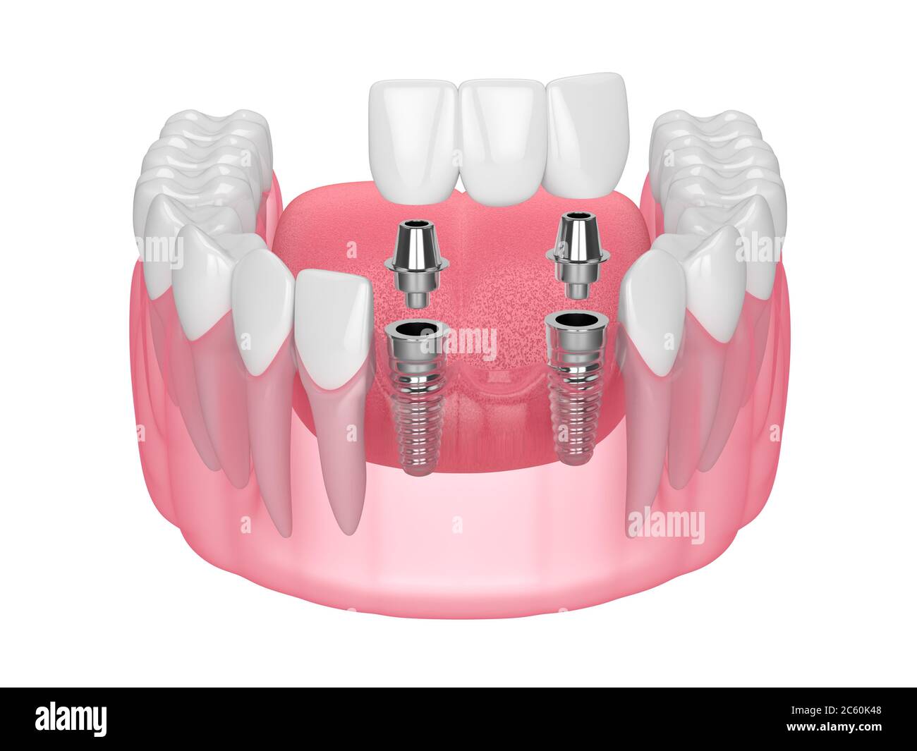Jaw implants supporting dental bridge hi-res stock photography and ...