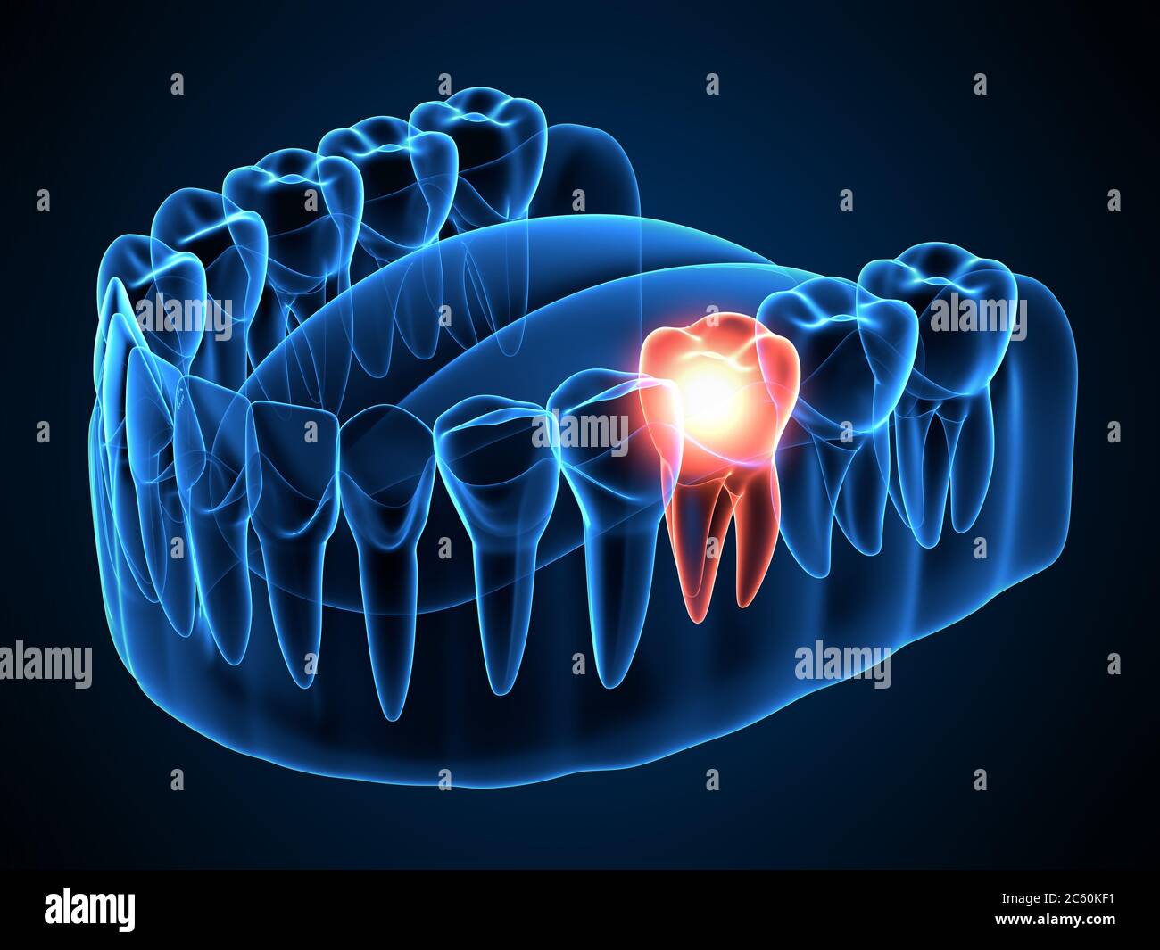 3d render of jaw x-ray with aching molar tooth. Toothache concept Stock ...